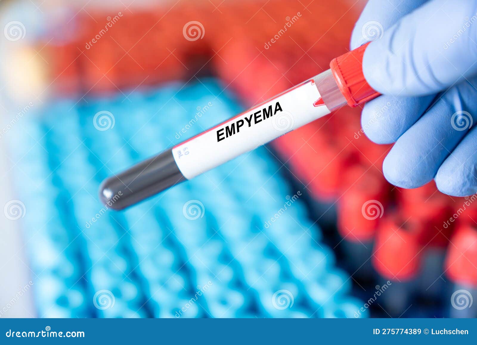 Empyema. Empyema Disease Blood Test in Doctor Hand Stock Image - Image ...