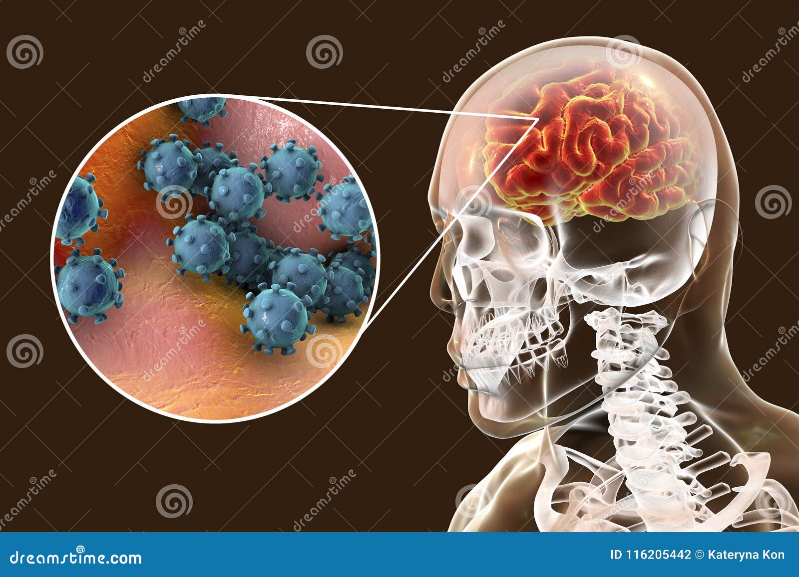 Encefalitis Viral, Concepto Médico Stock de ilustración - Ilustración ...