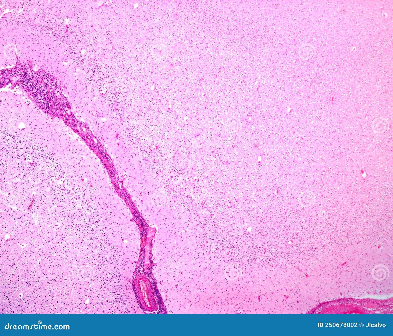 Encephalitis by Haemophilus Influenzae Stock Photo - Image of pathology ...