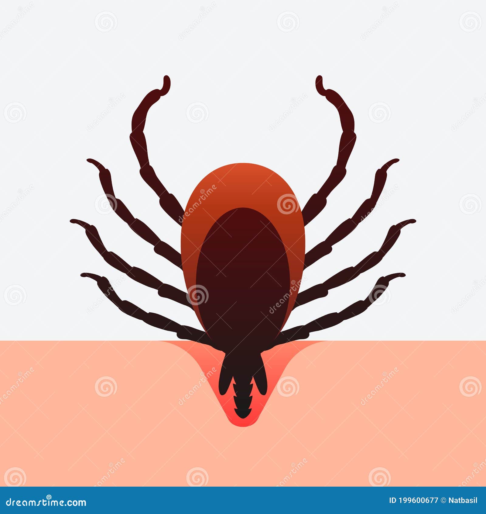 Encephalitis Mite Bites through Human Skin Stock Vector - Illustration ...