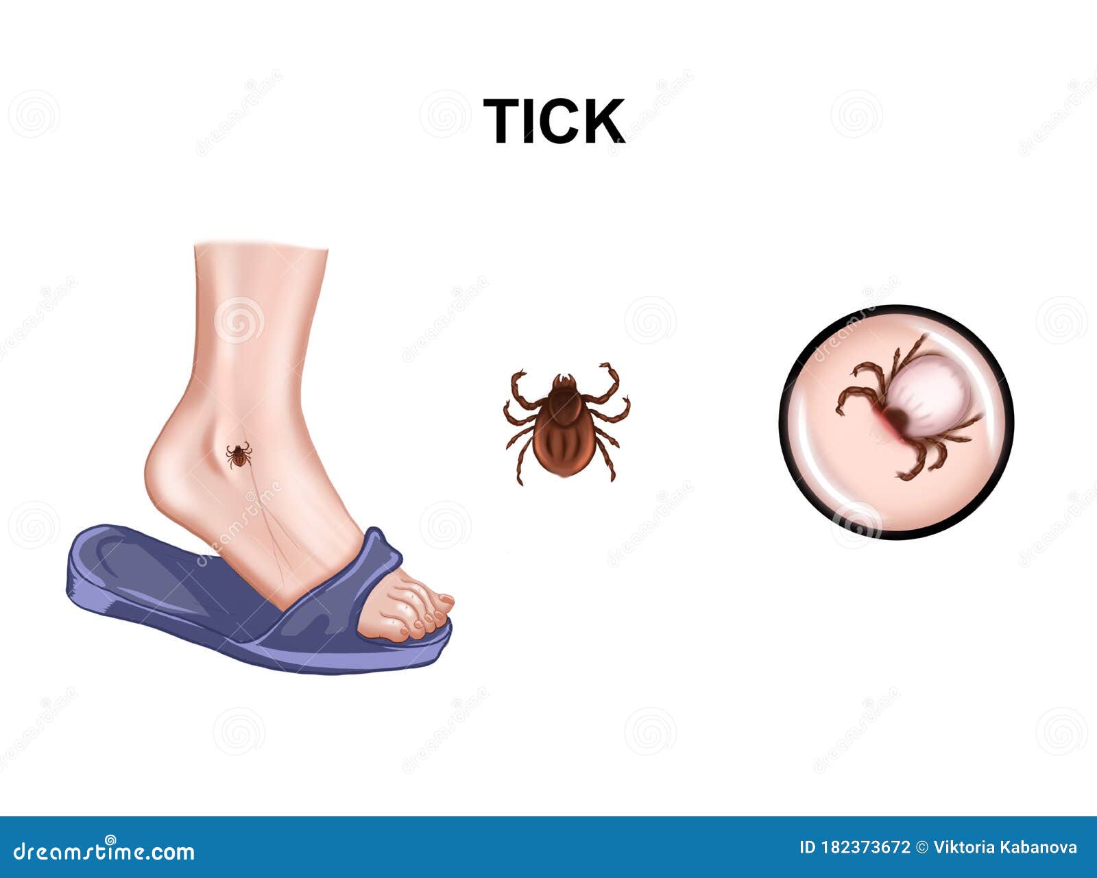 Tick Bite. Infographic Of Human Protection From Tick Borreliosis Nature ...
