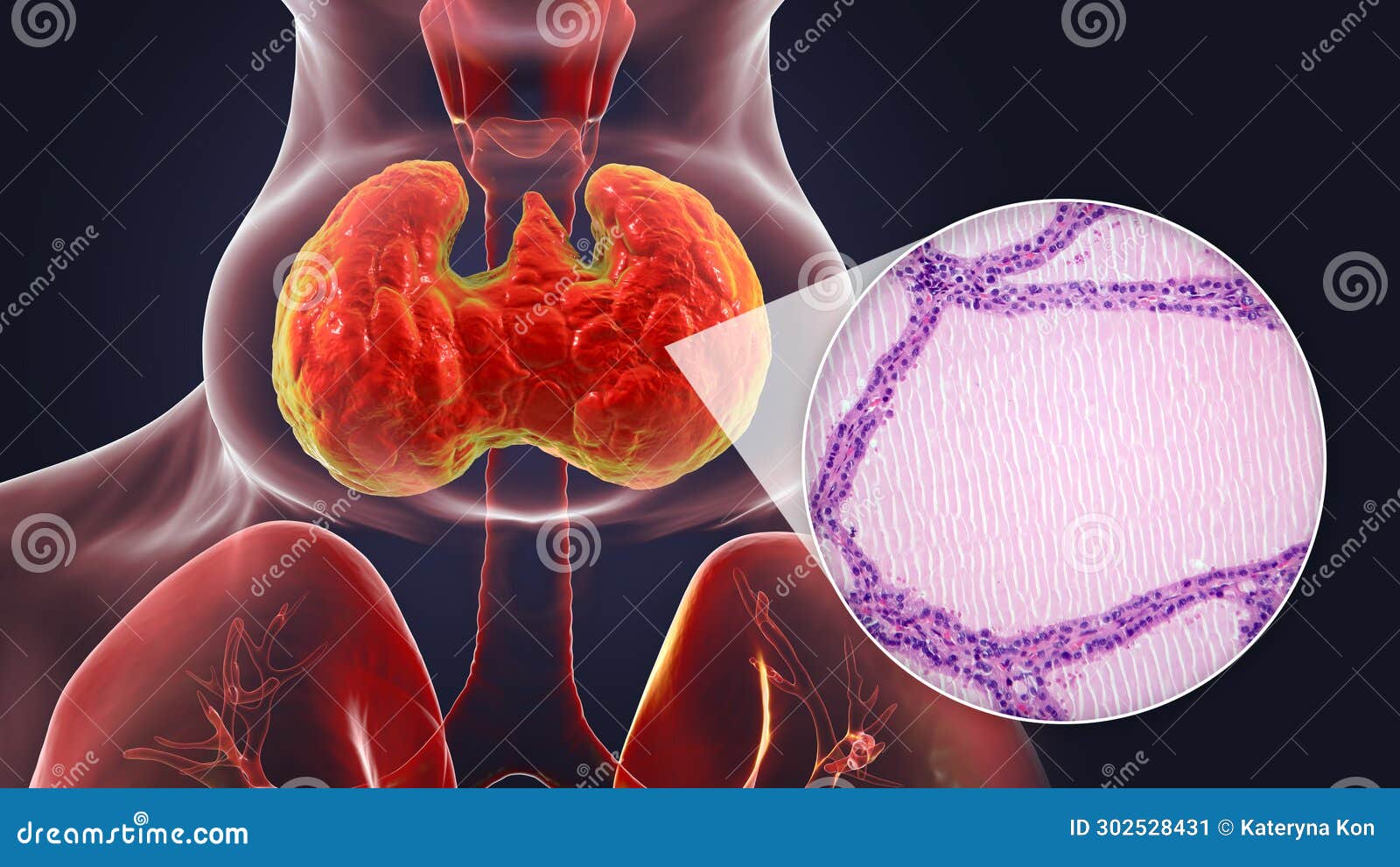 Endemic Goiter, 3D Illustration and Light Micrograph Stock Illustration ...
