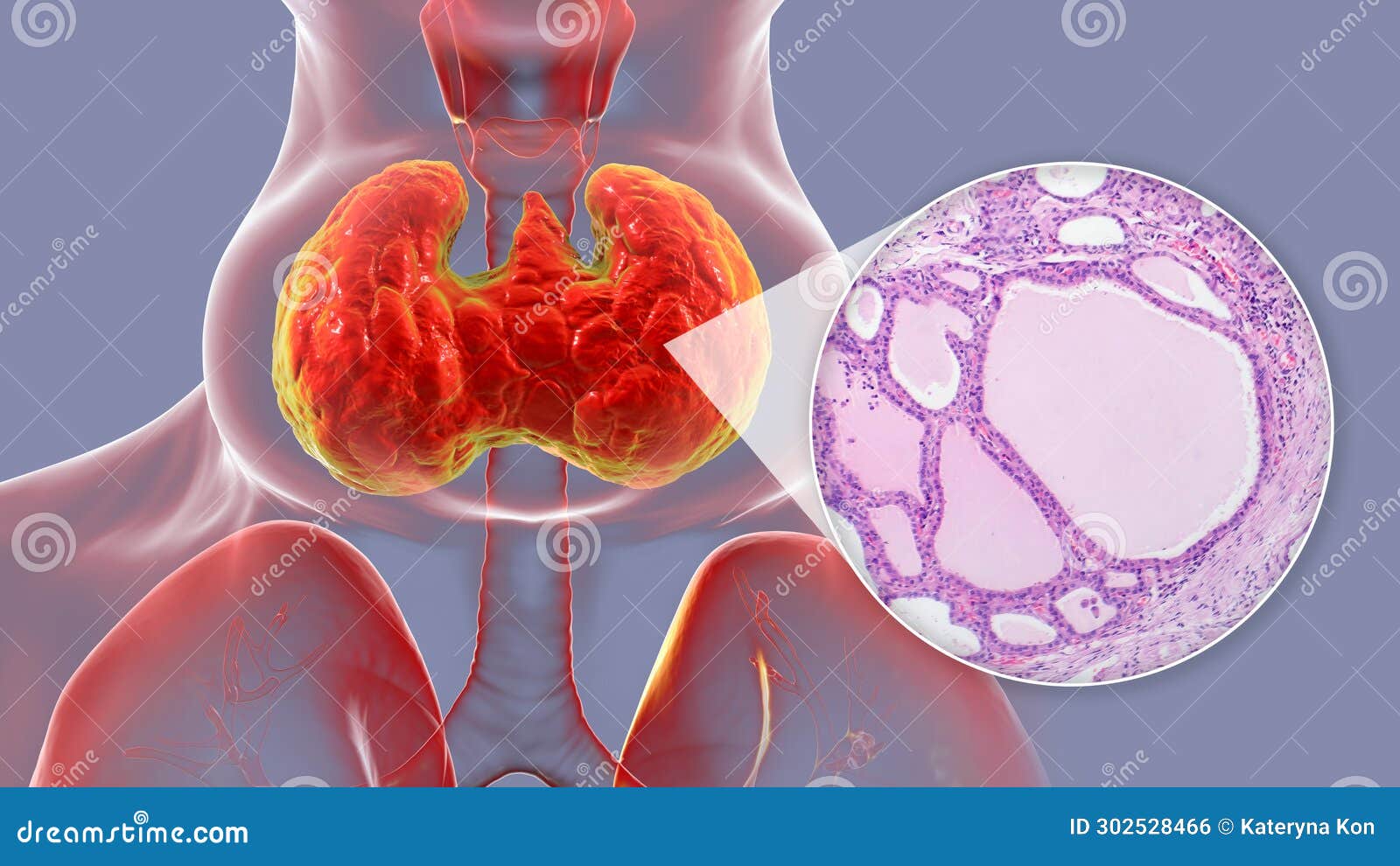 Endemic Goiter, 3D Illustration and Light Micrograph Stock Illustration ...