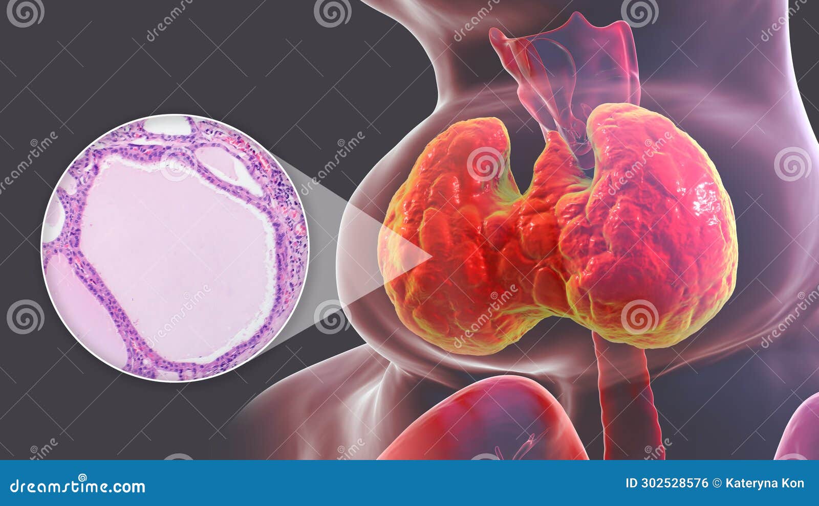Endemic Goiter, 3D Illustration and Light Micrograph Stock Illustration ...