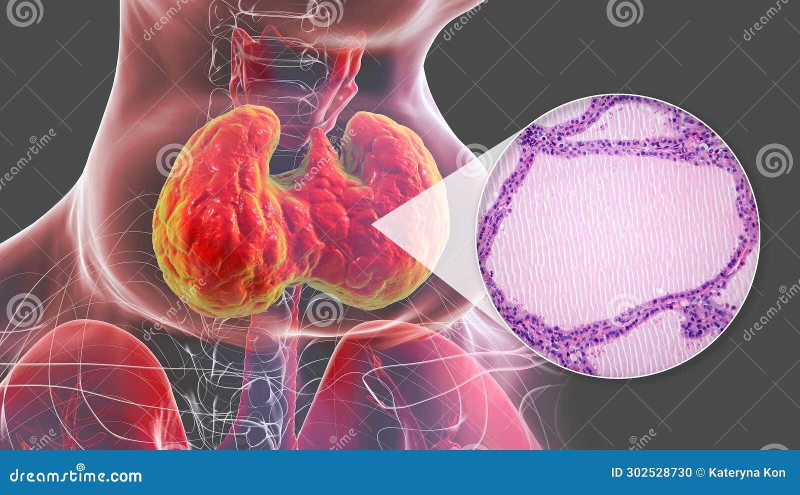 Endemic Goiter, 3D Illustration And Light Micrograph | CartoonDealer ...