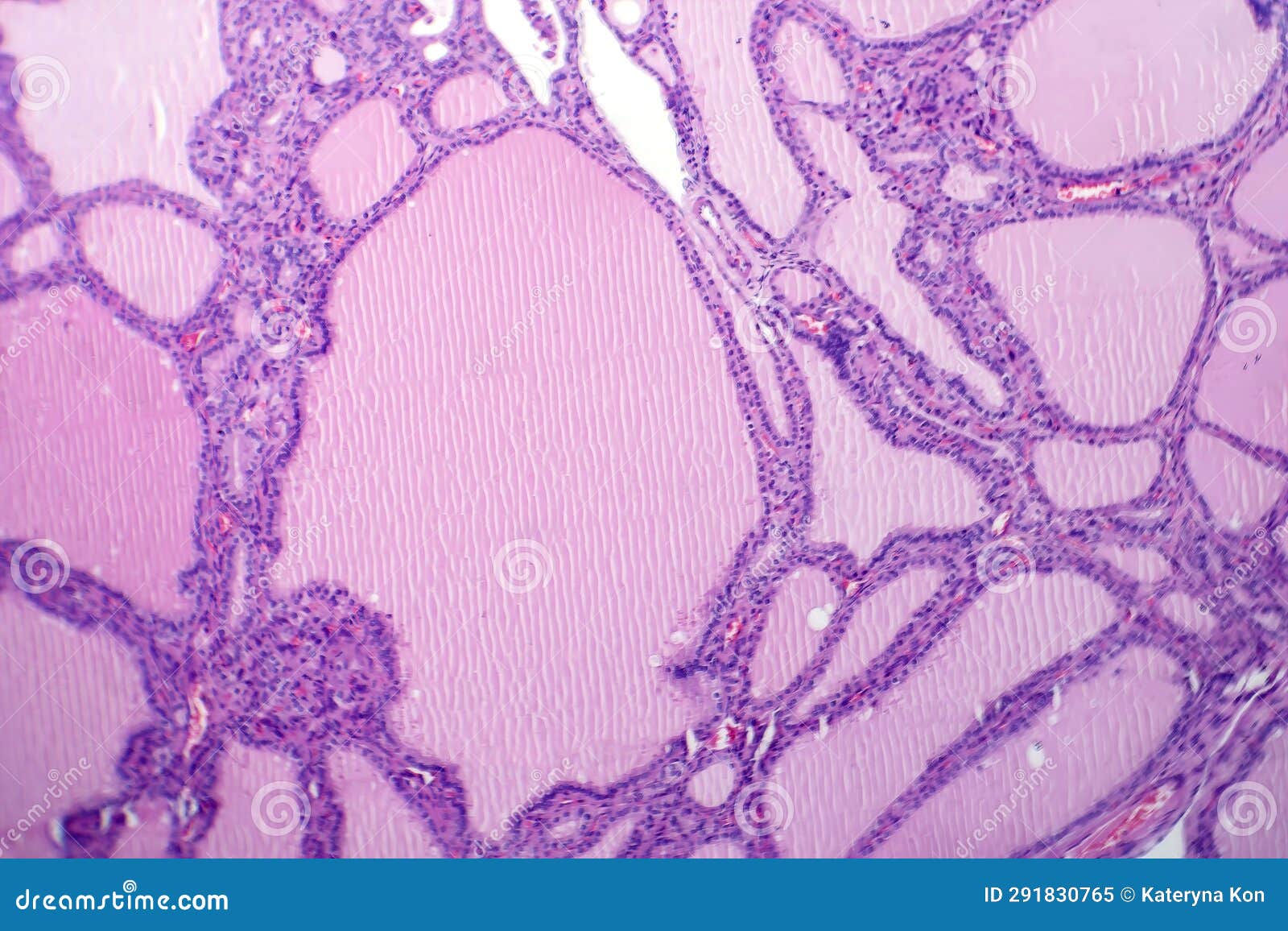 Endemic Goiter, Light Micrograph Stock Image - Image of thyroid ...