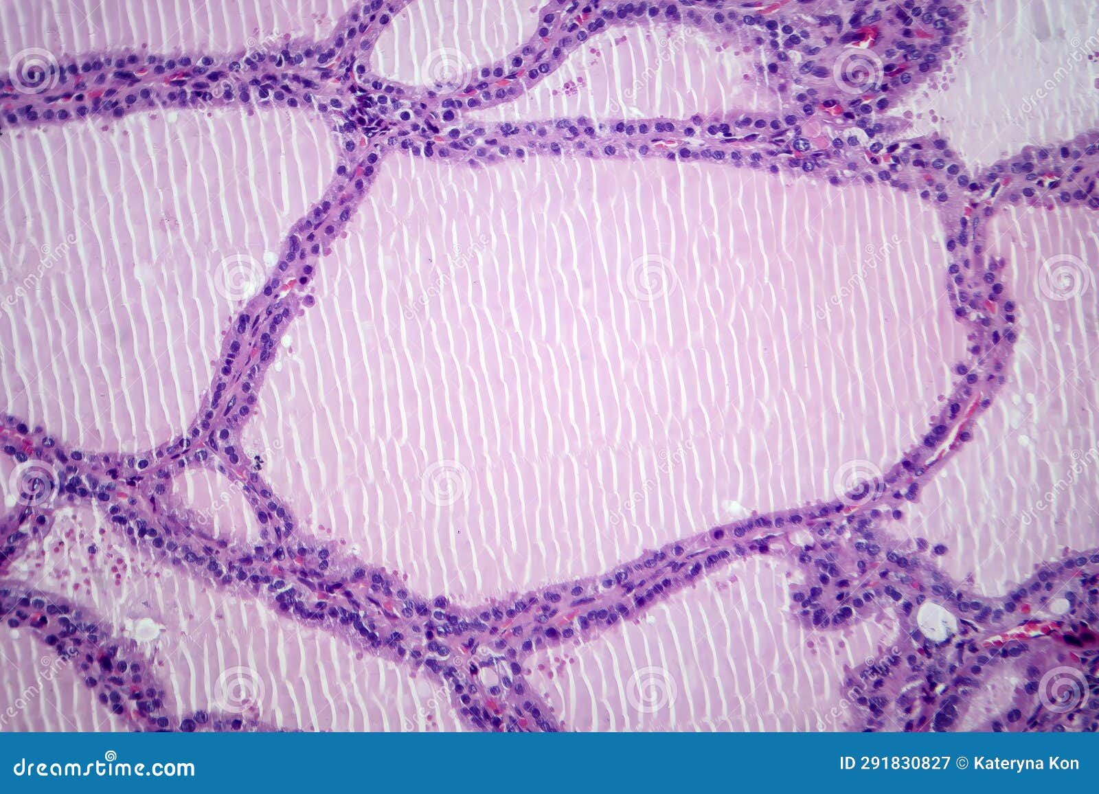 Endemic Goiter, Light Micrograph Stock Image - Image of disorder, cells ...