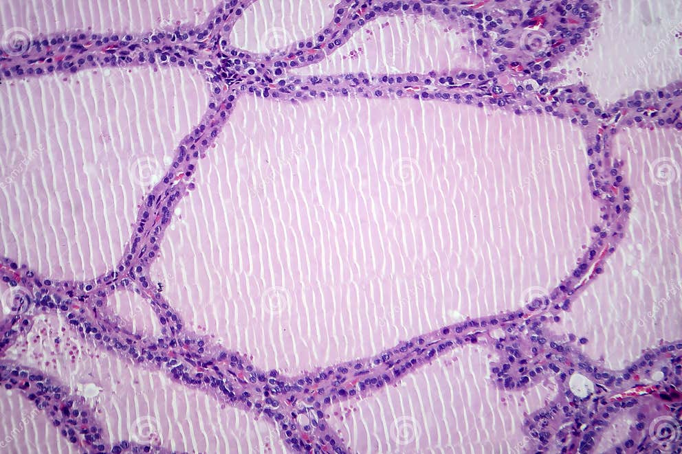 Endemic Goiter, Light Micrograph Stock Photo - Image of nodular ...