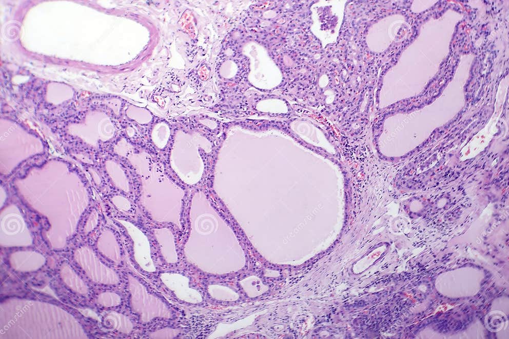 Endemic Goiter, Light Micrograph Stock Image - Image of deficiency ...