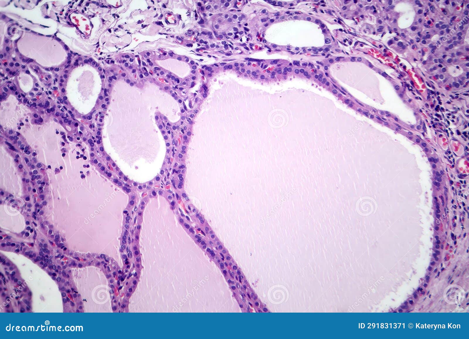 Endemic Goiter, Light Micrograph Stock Image - Image of cells, thyroid ...