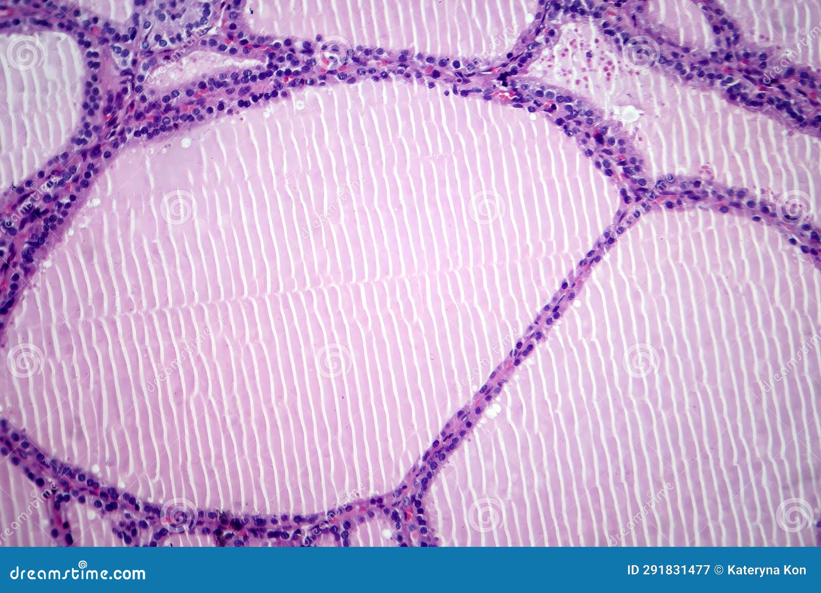 Endemic Goiter, Light Micrograph Stock Image - Image of thyroid ...