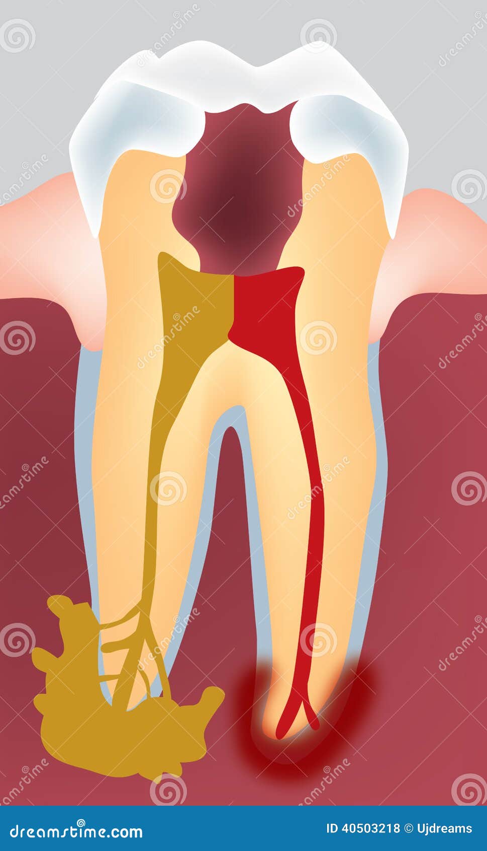 Endodoncia ilustración del vector. Ilustración de implante - 40503218