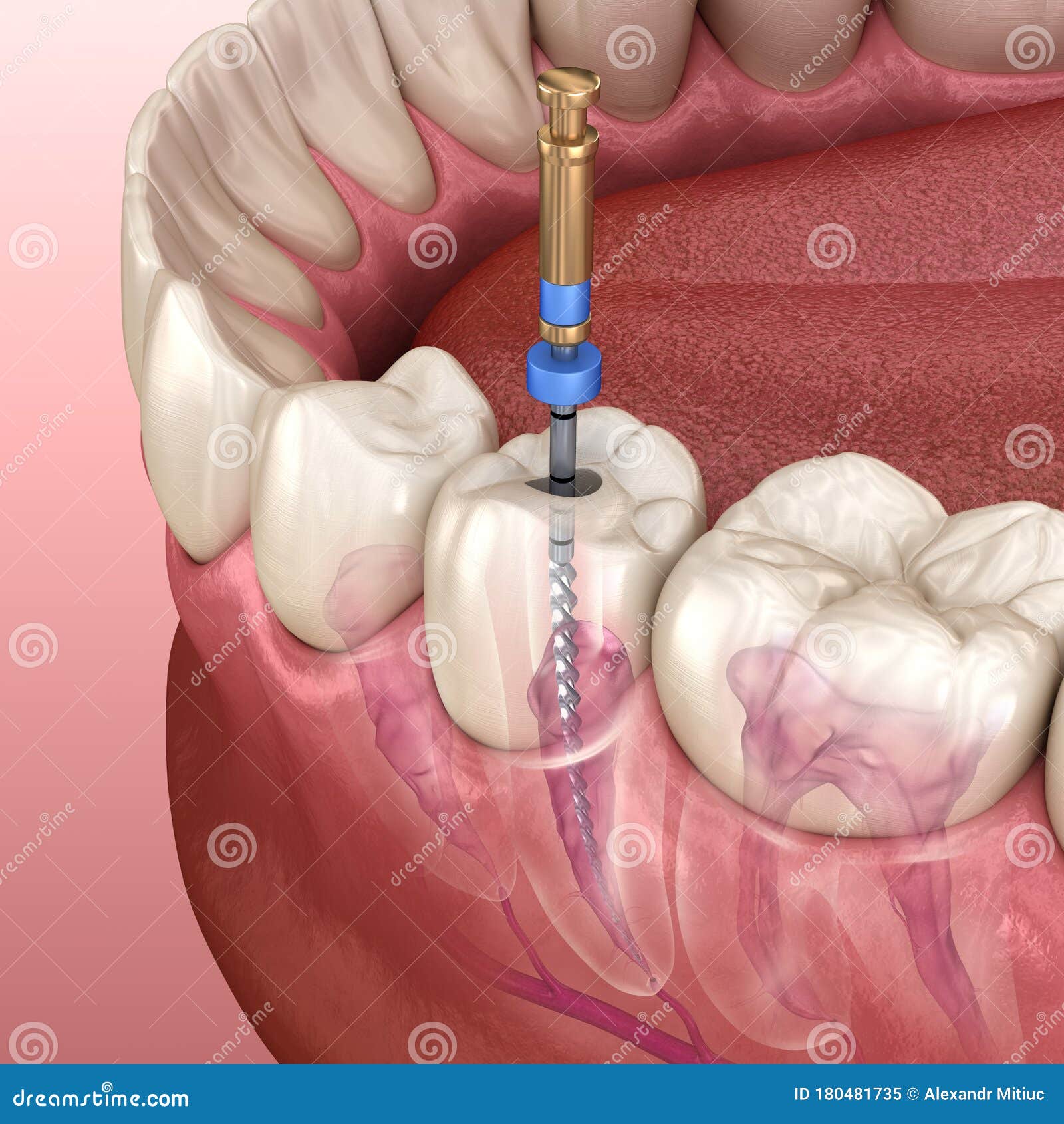 Endodontic Root Canal Treatment Process. Medically Accurate Tooth ...
