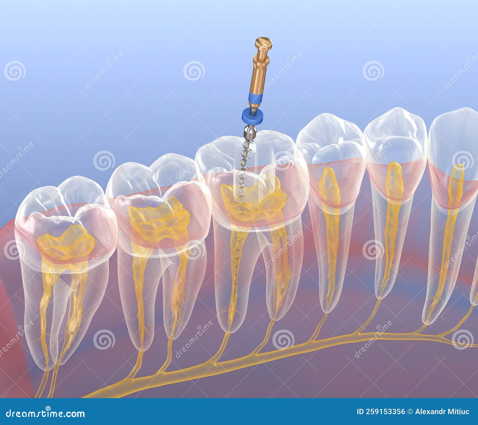 Root Canal Treatment. Medical Infographic Or Diagram With Stages Of ...