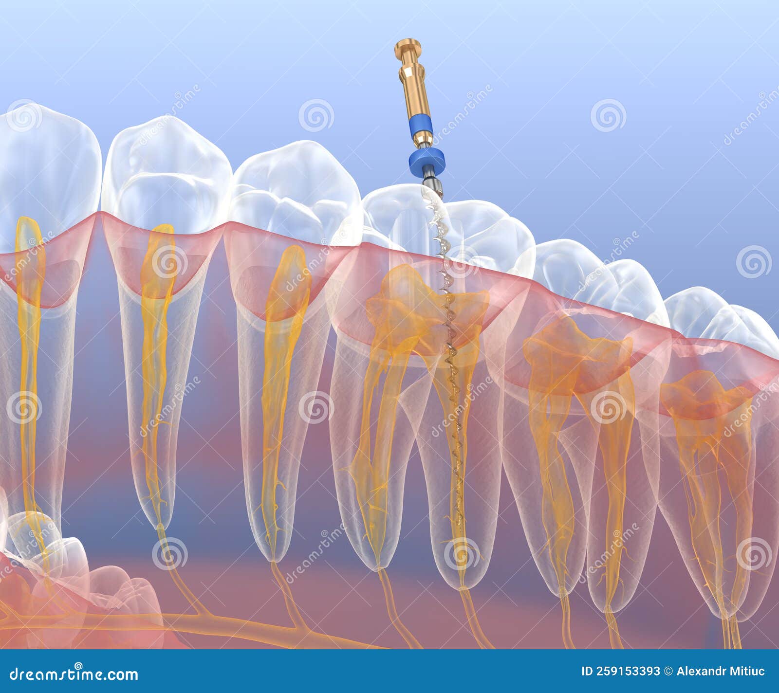 Endodontic Root Canal Treatment Process. Medically Accurate Tooth 3D ...