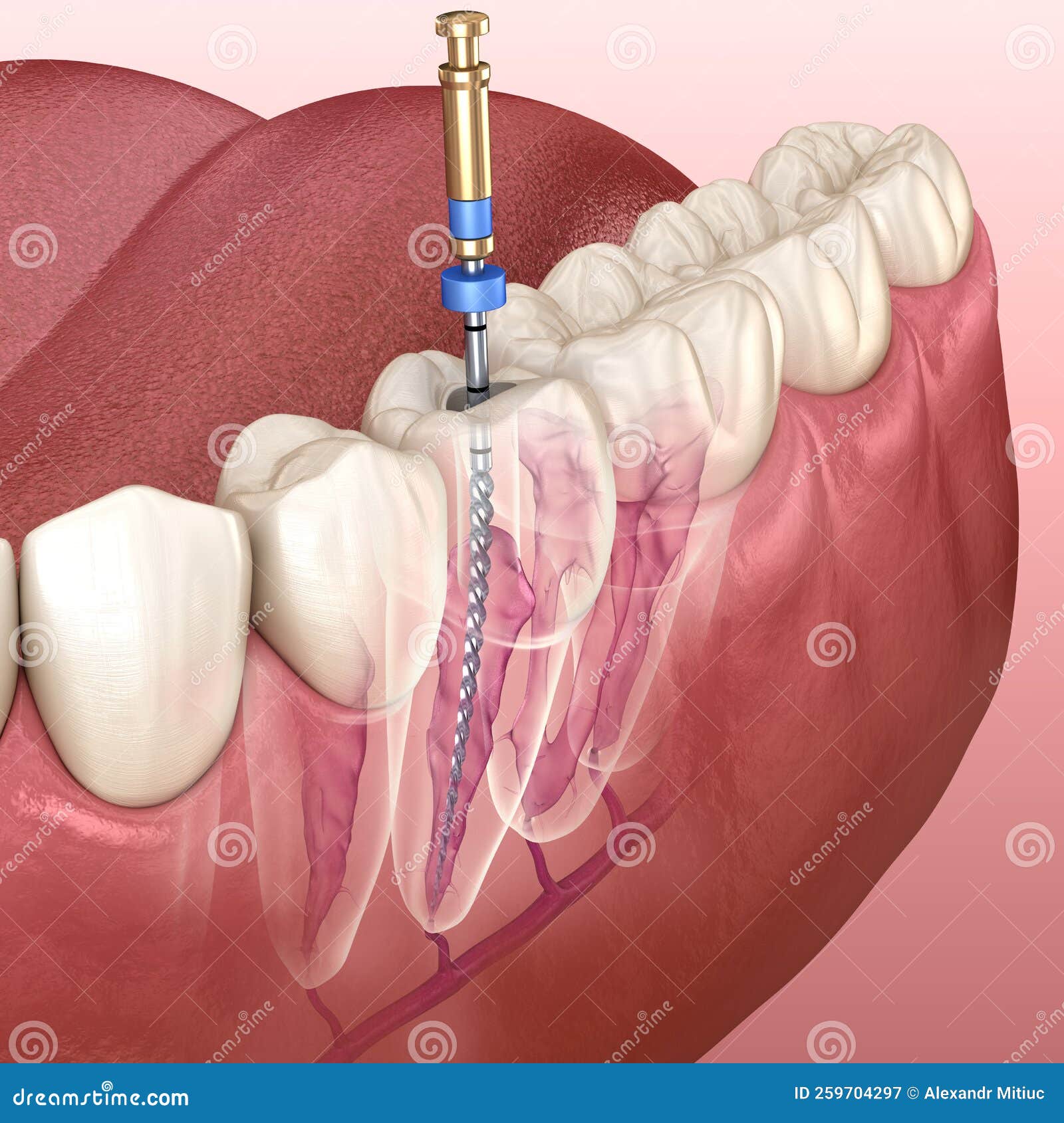 Endodontic Root Canal Treatment Process. Medically Accurate Tooth ...