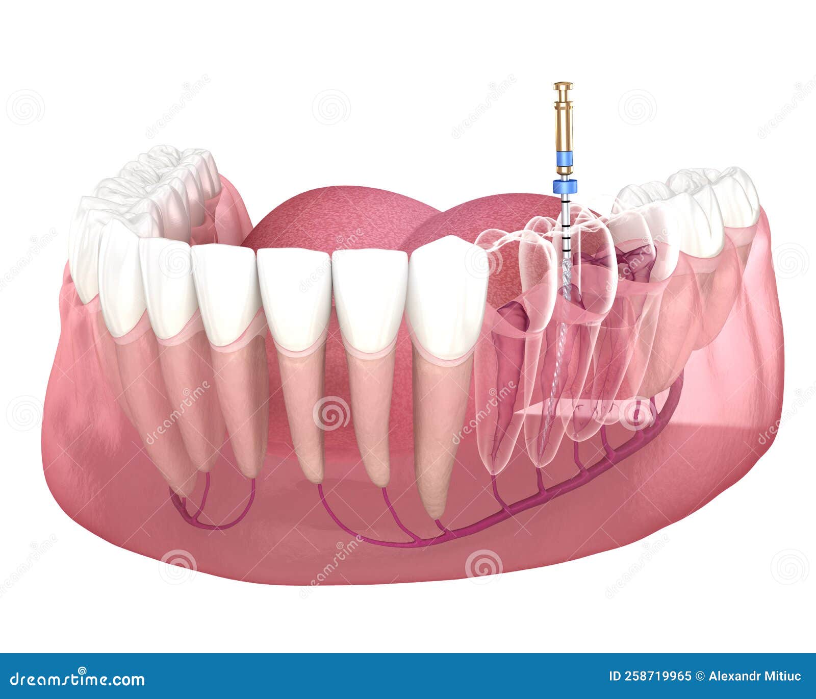 Endodontic Root Canal Treatment Process. Medically Accurate Tooth 3D ... Endodontic Root Canal Treatment Process. Medically Accurate Tooth 3D ...