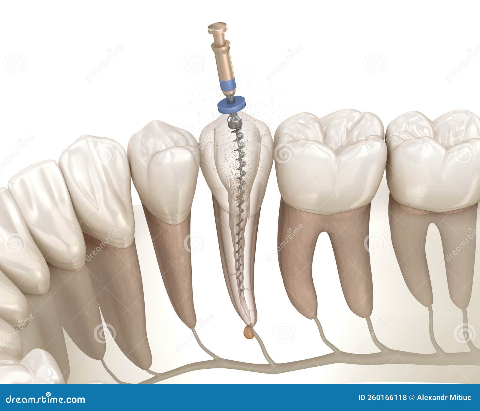 Endodontic Root Canal Treatment Process. Medically Accurate Tooth 3D ... Endodontic Root Canal Treatment Process. Medically Accurate Tooth 3D ...