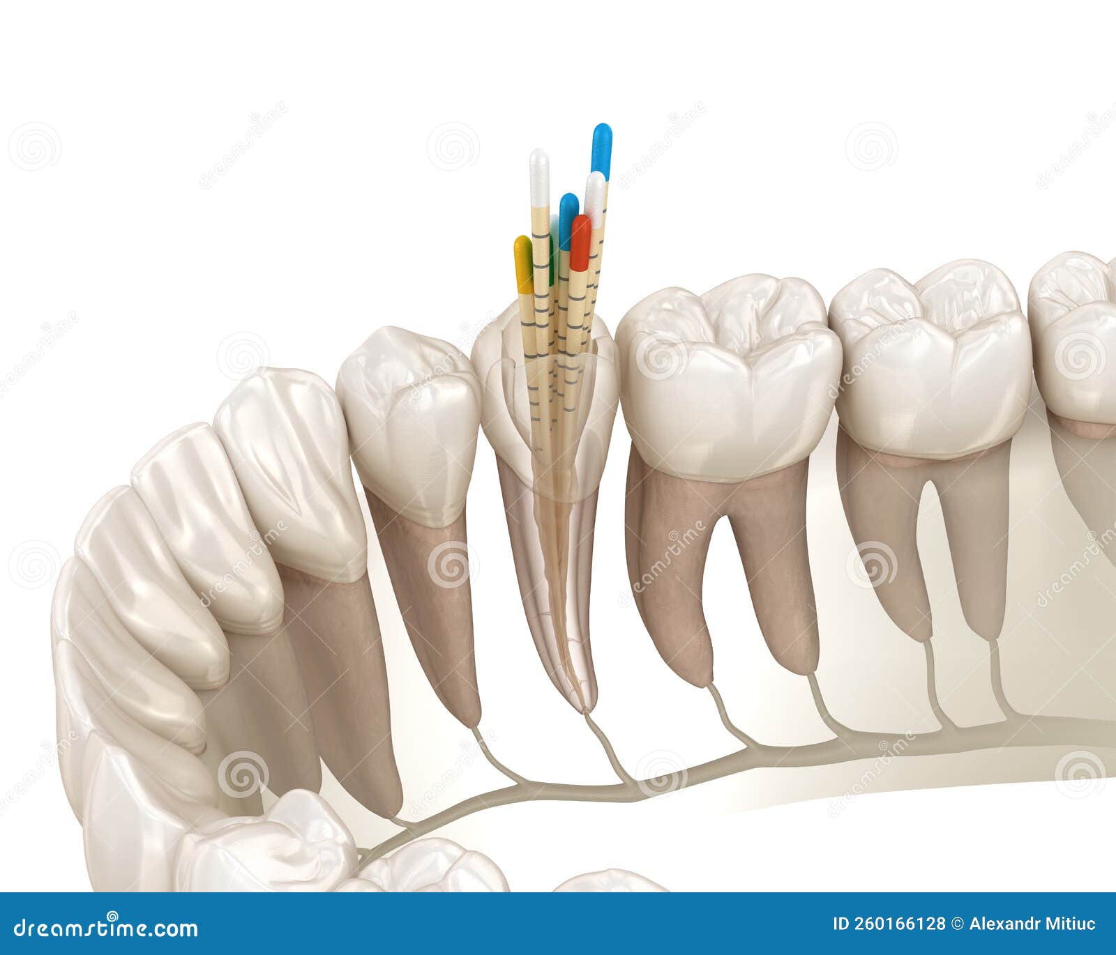 Endodontic Root Canal Treatment Process. Medically Accurate Tooth 3D ... Endodontic Root Canal Treatment Process. Medically Accurate Tooth 3D ...