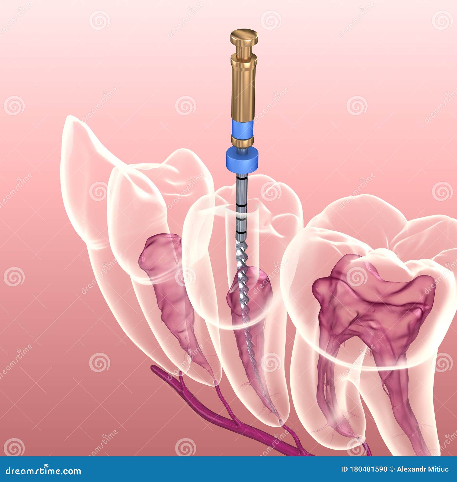 Endodontic Root Canal Treatment Process. Medically Accurate Tooth ...