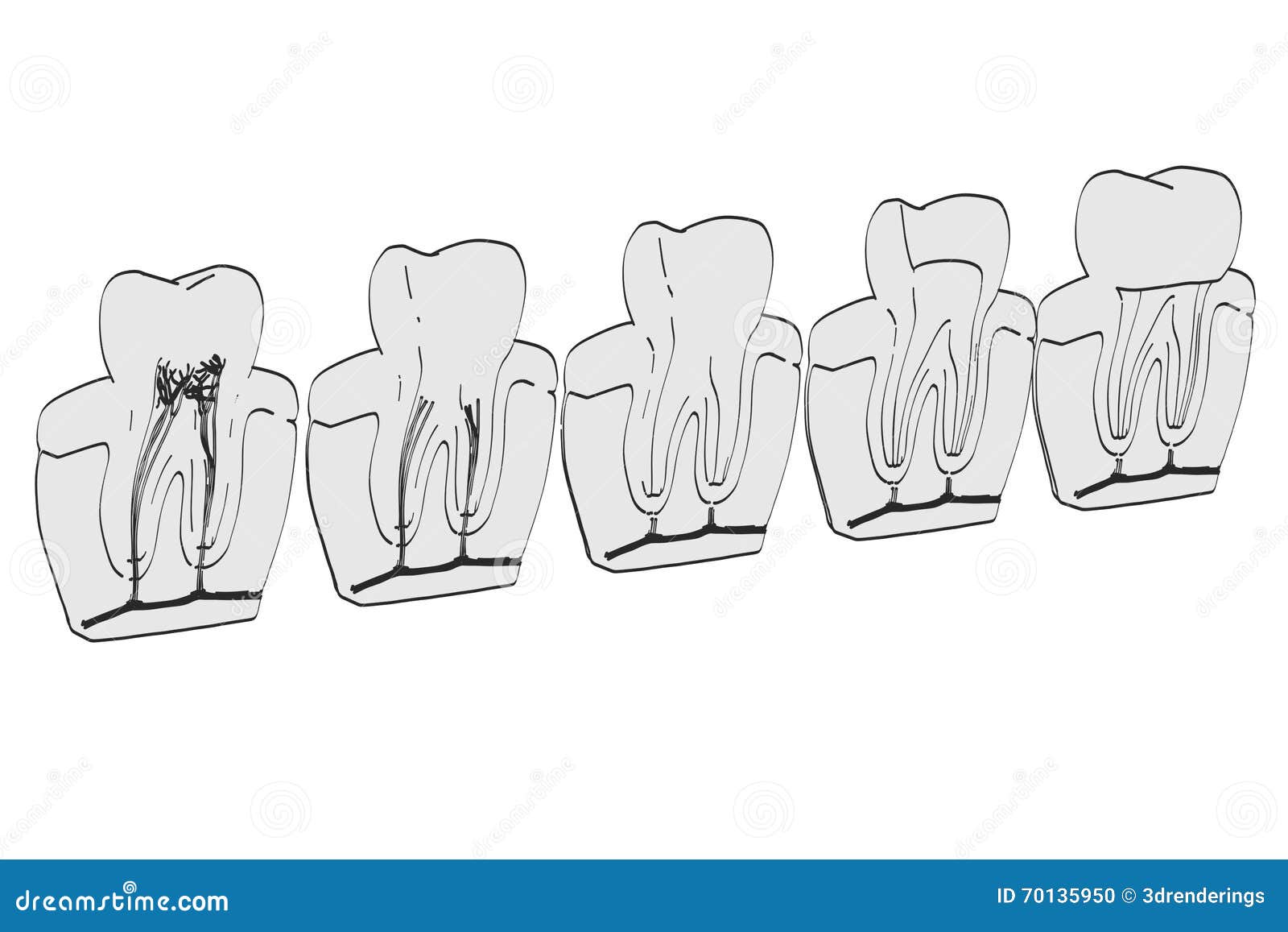 Endodontics stock illustration. Illustration of cutaway - 70135950