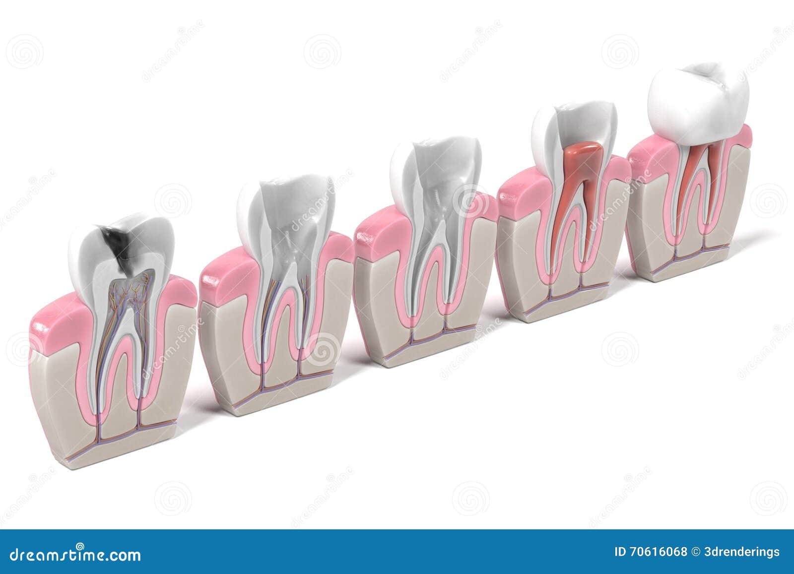 Endodontics Cartoons, Illustrations & Vector Stock Images - 543 ...