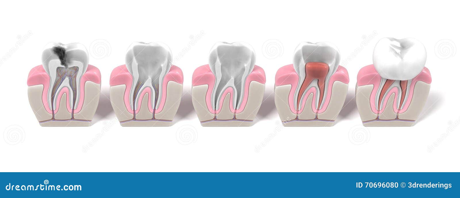 Endodontics - Procedimiento De La Endodoncia Stock de ilustración ...