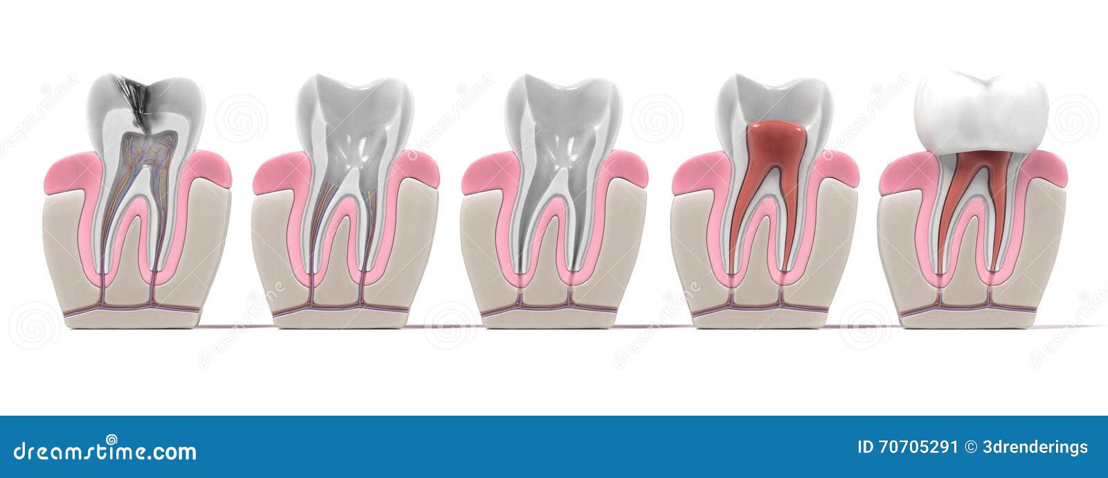 Endodontics - Root Canal Procedure Stock Illustration - Illustration of ...