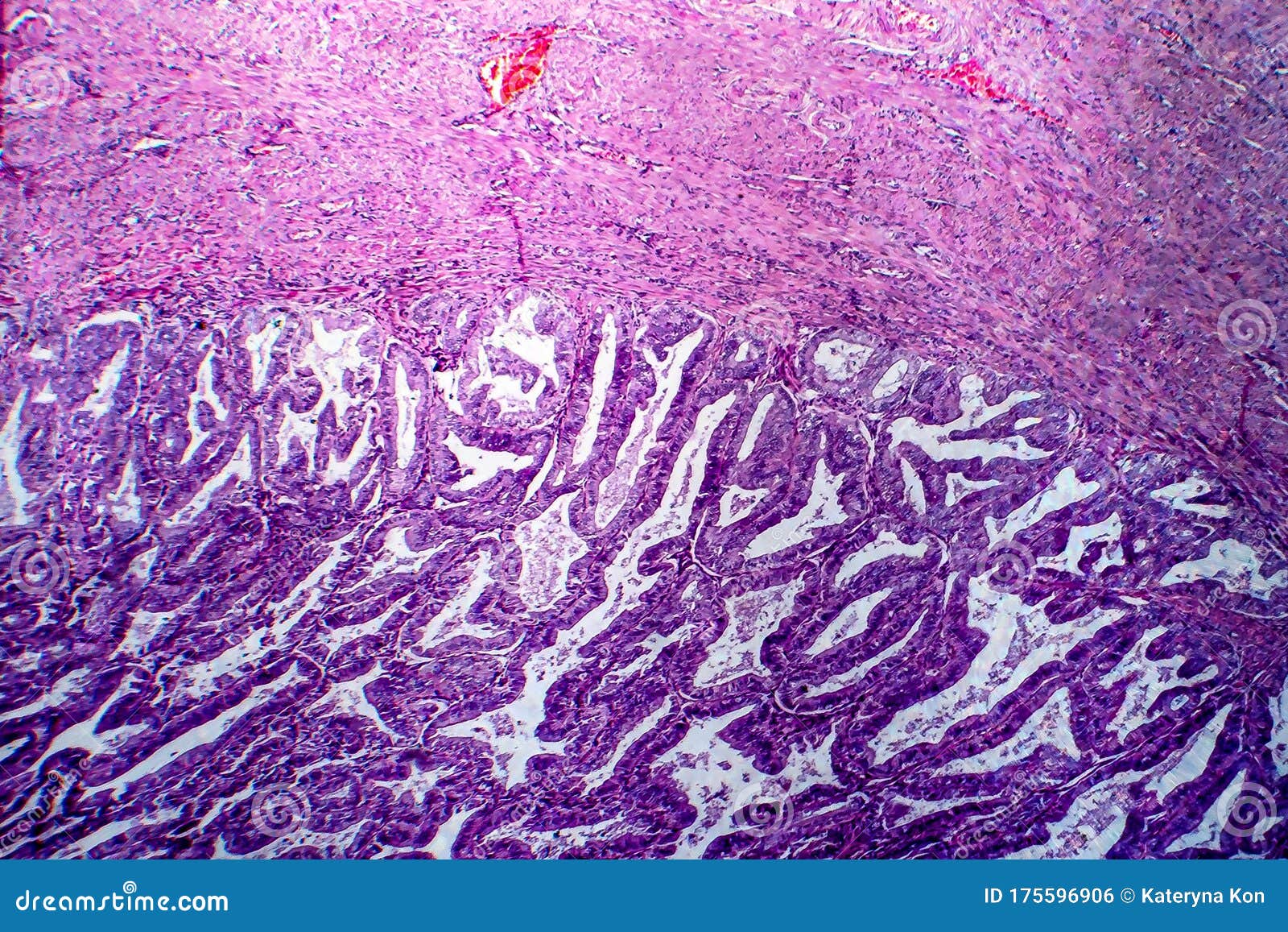 Endometrial Adenocarcinoma, Light Micrograph Stock Photo - Image of ...