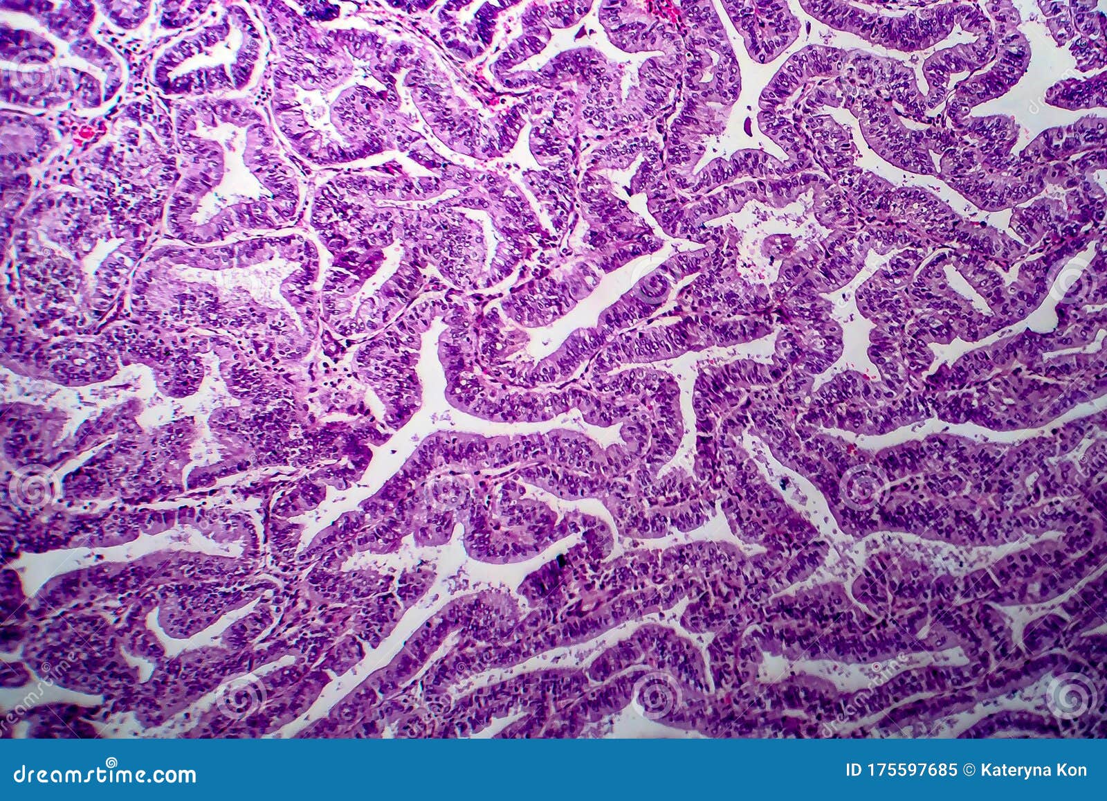 Endometrial Adenocarcinoma, Light Micrograph Stock Image - Image of ...