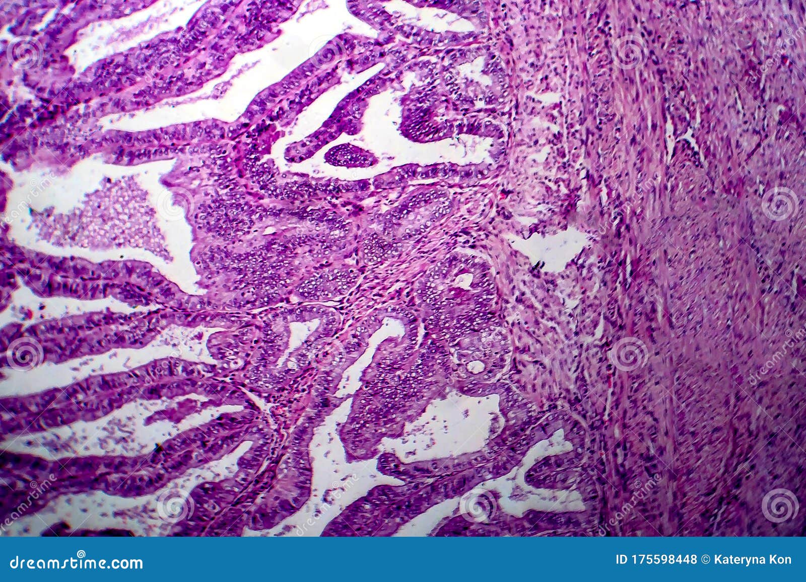 Endometrial Adenocarcinoma, Light Micrograph Stock Photo - Image of ...