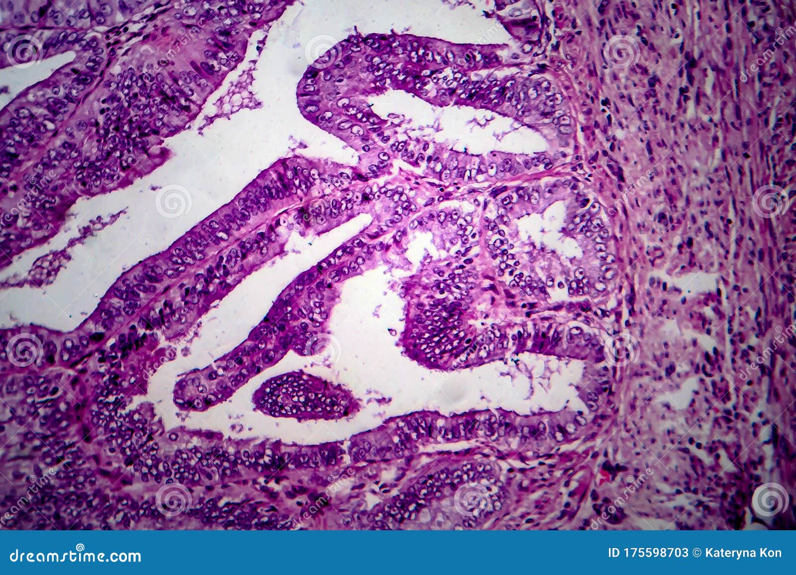 Endometrial Adenocarcinoma, Light Micrograph Stock Image - Image of ...