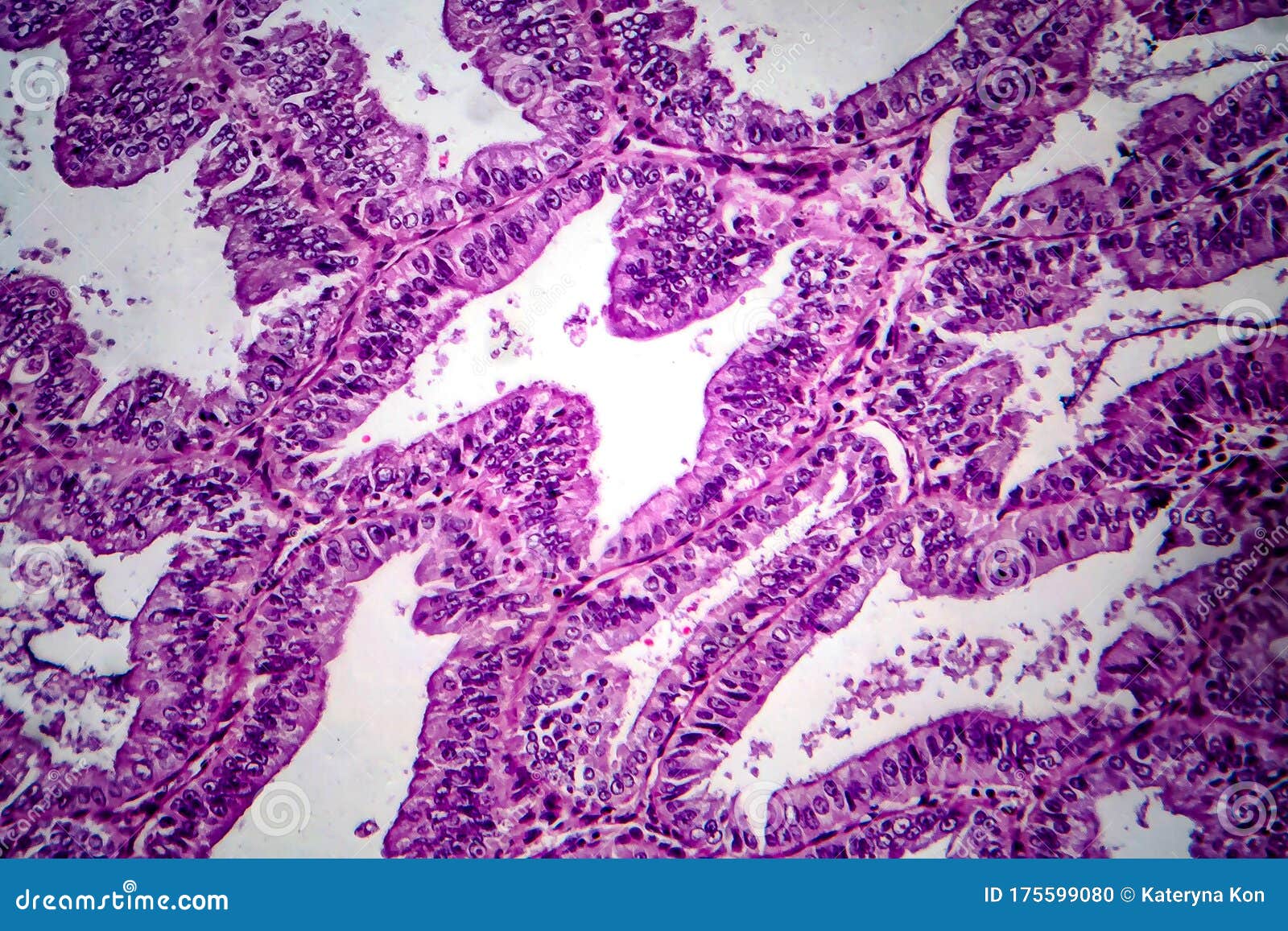 Endometrial Adenocarcinoma, Light Micrograph Stock Photo - Image of ...