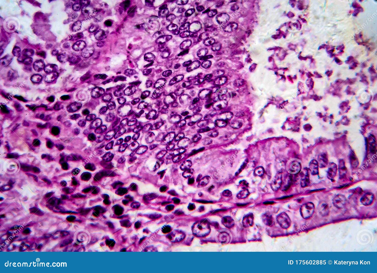 Endometrial Adenocarcinoma, Light Micrograph Stock Image - Image of ...