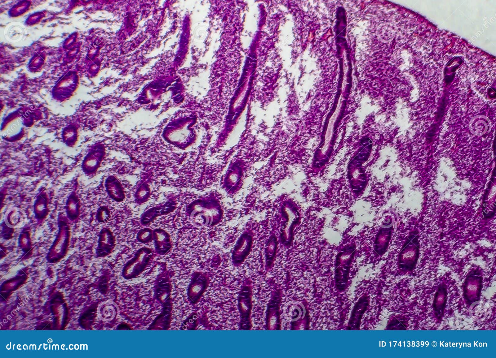 Endometrial Hyperplasia, Light Micrograph Stock Image - Image of ...