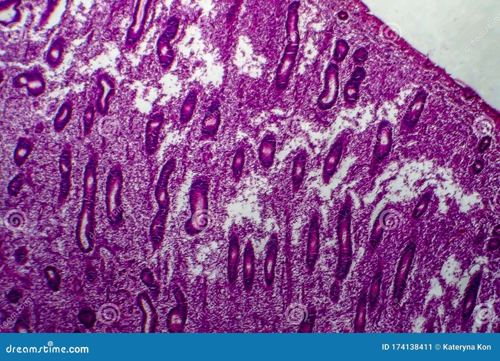 Endometrial Hyperplasia, Light Micrograph Royalty-Free Stock Photo ...
