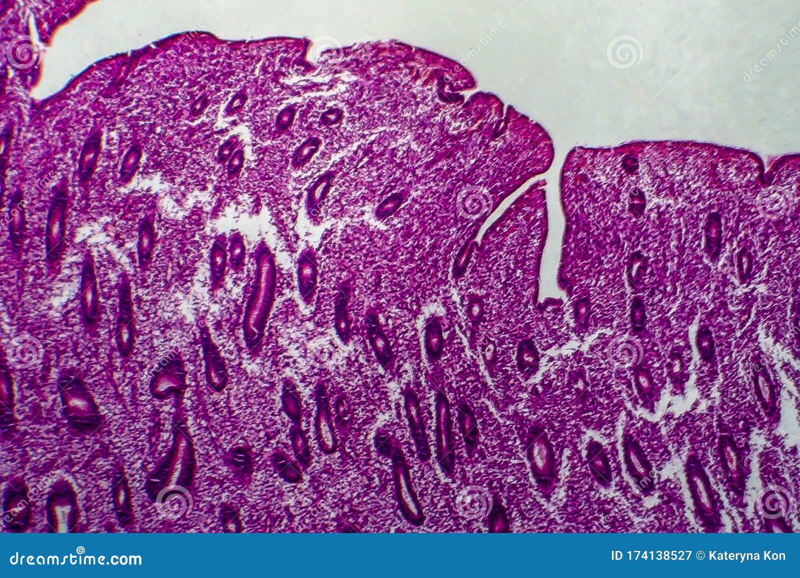 Endometrial Hyperplasia, Light Micrograph Stock Image - Image of tissue ...
