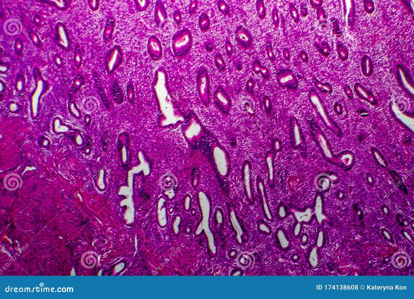 Endometrial Hyperplasia, Light Micrograph Stock Photo - Image of ...