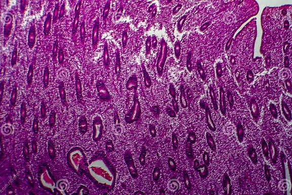 Endometrial Hyperplasia, Light Micrograph Stock Photo - Image of ...