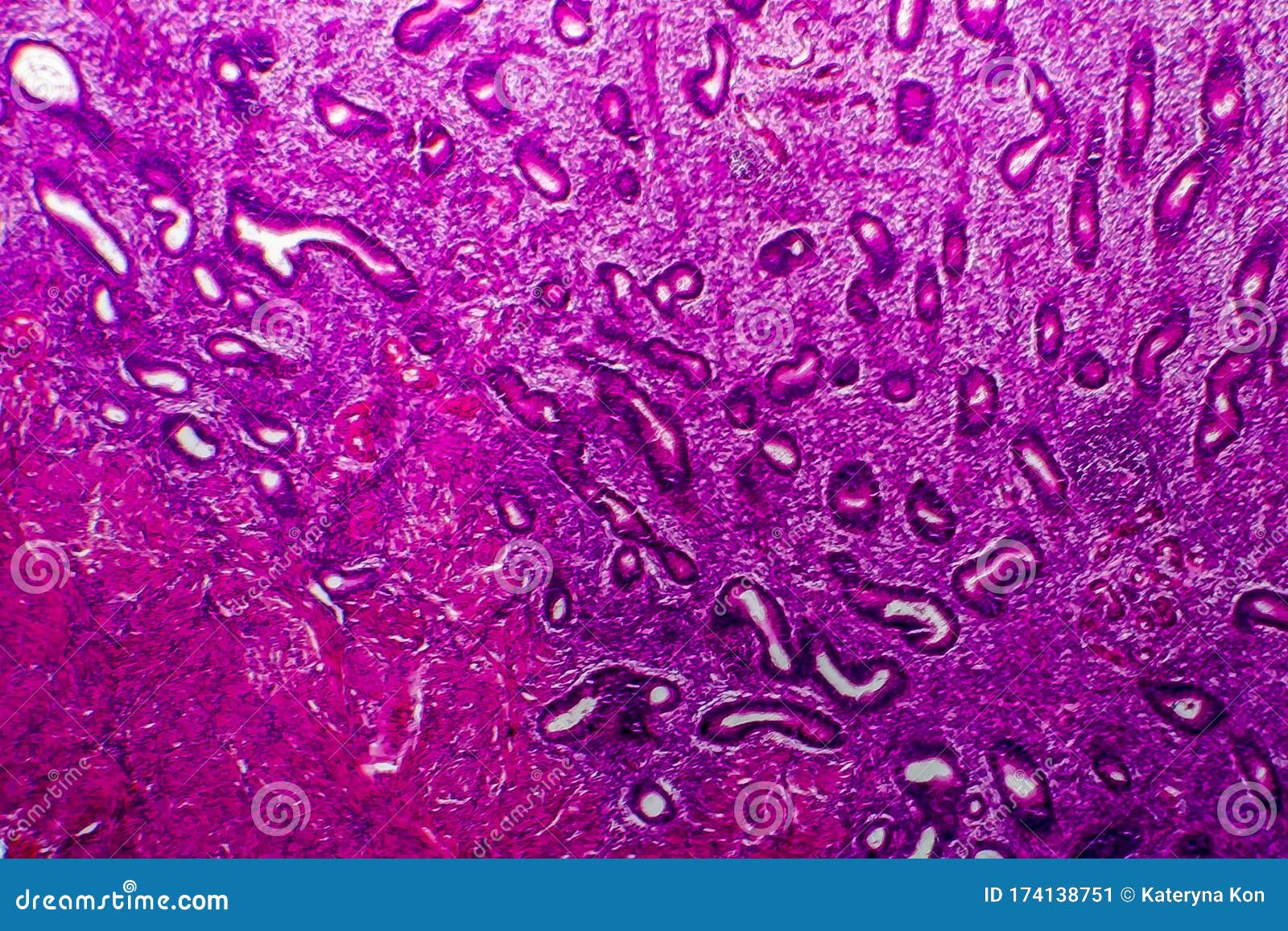Endometrial Hyperplasia, Light Micrograph Stock Image - Image of uterus ...