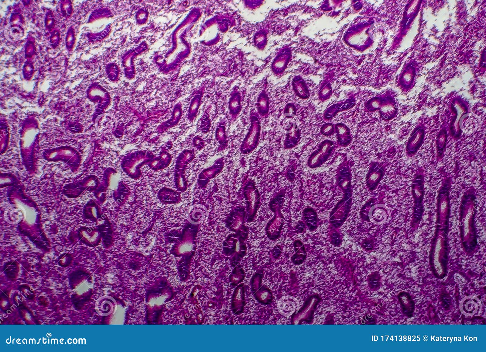 Endometrial Hyperplasia, Light Micrograph Stock Image - Image of glands ...