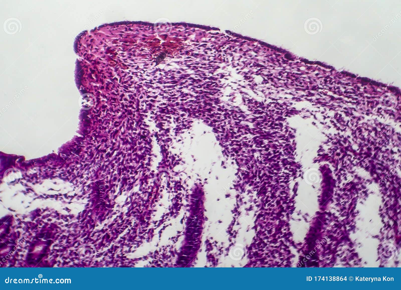 Endometrial Hyperplasia, Light Micrograph Royalty-Free Stock Photo ...