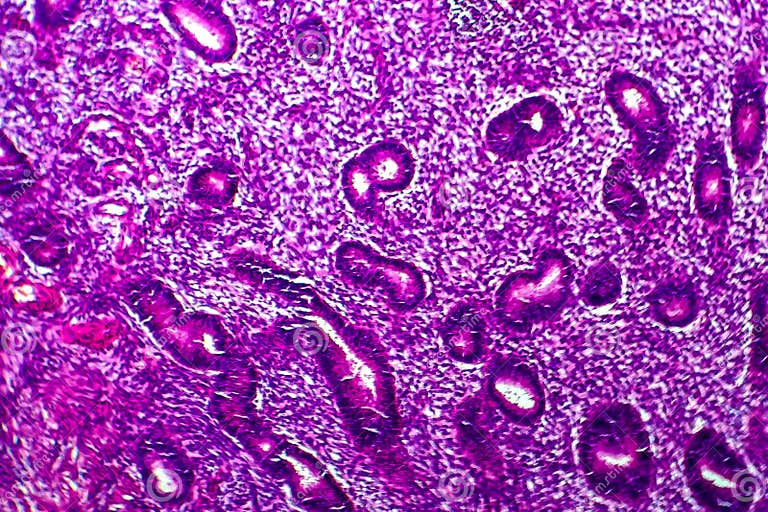 Endometrial Hyperplasia, Light Micrograph Stock Photo - Image of ...