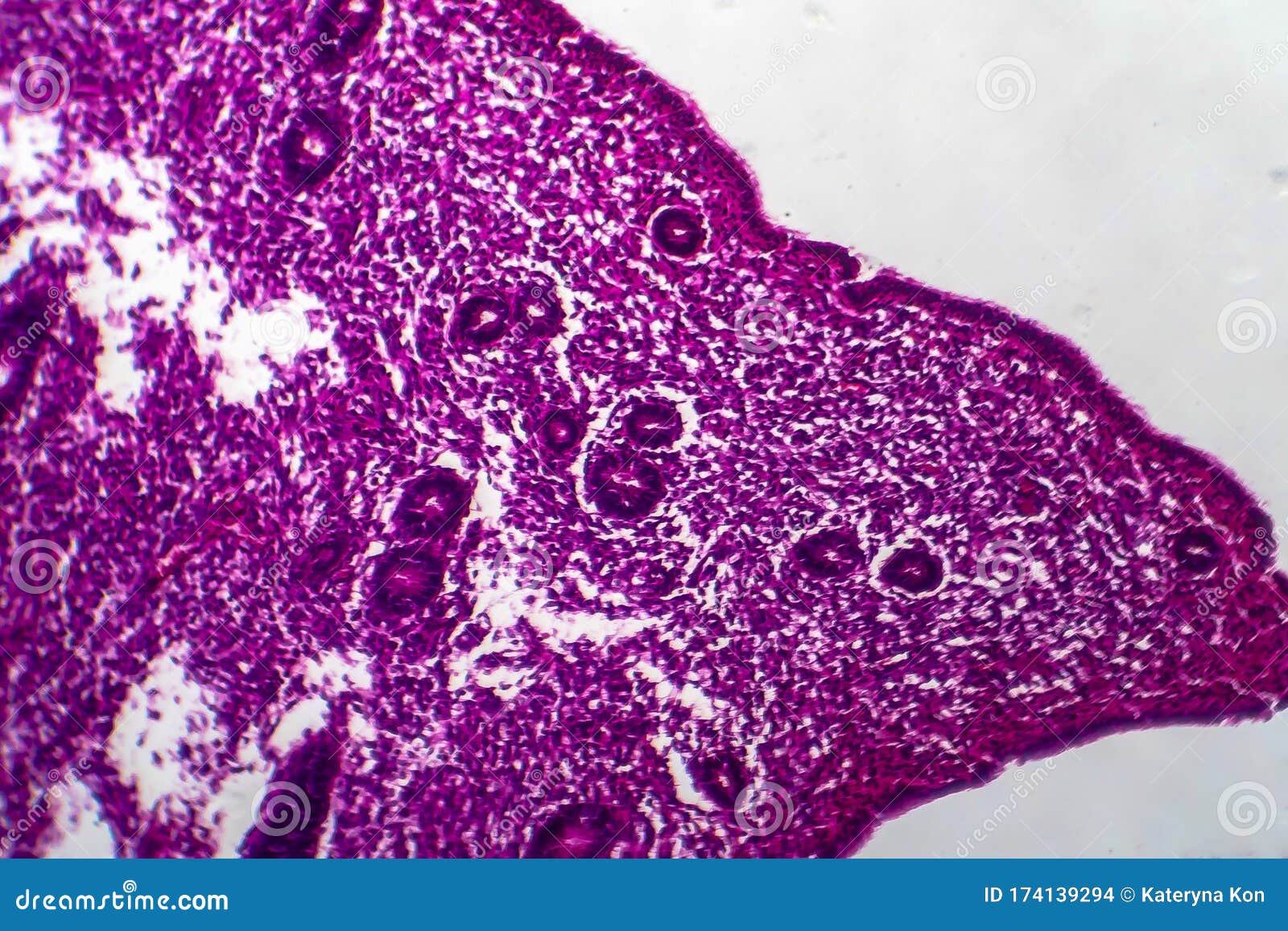 Endometrial Hyperplasia, Light Micrograph Stock Photo - Image of stain ...