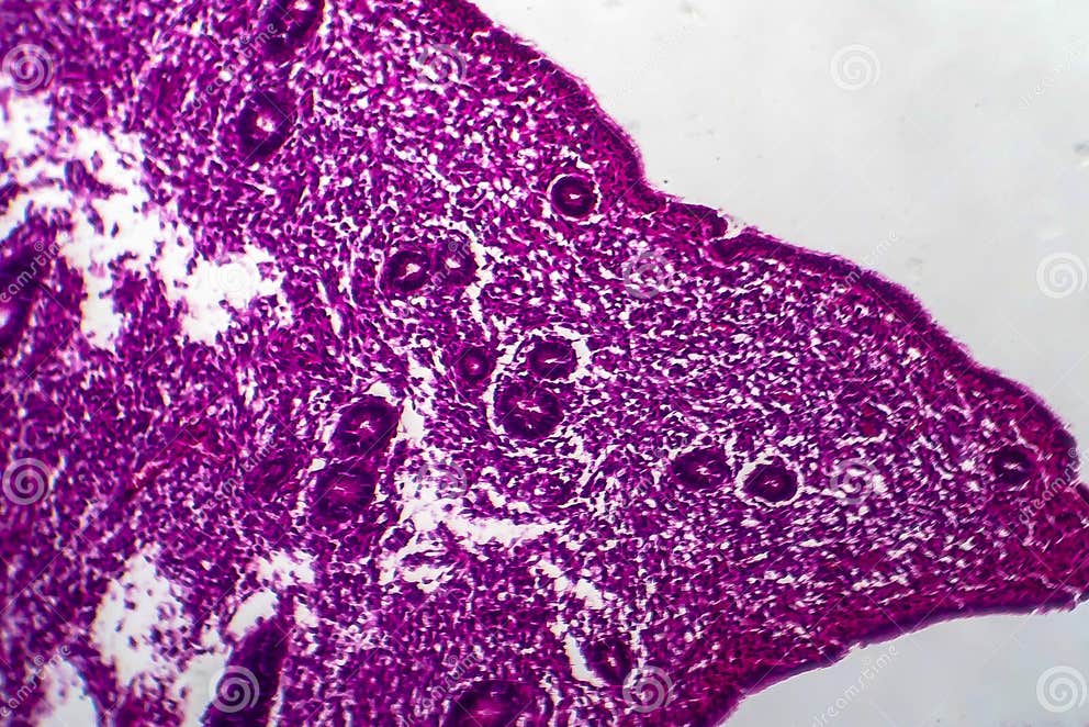 Endometrial Hyperplasia, Light Micrograph Stock Photo - Image of stain ...