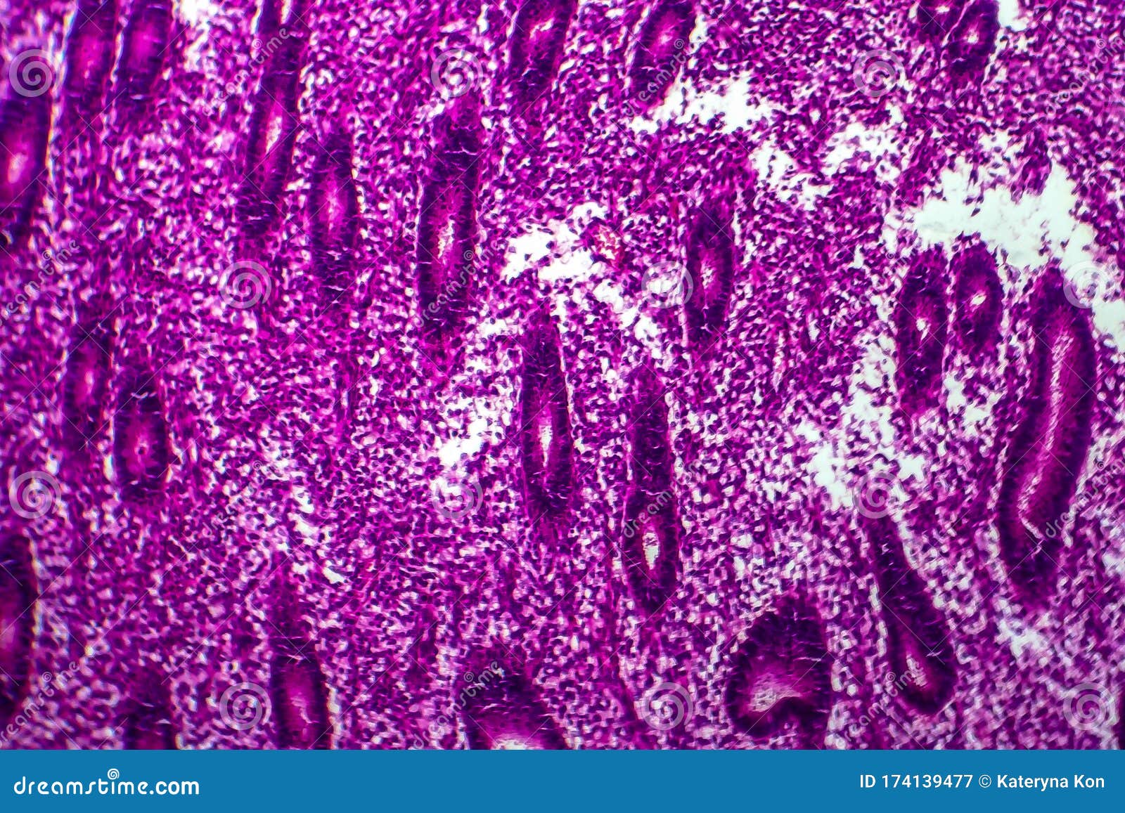 Endometrial Hyperplasia, Light Micrograph Stock Image - Image of ...