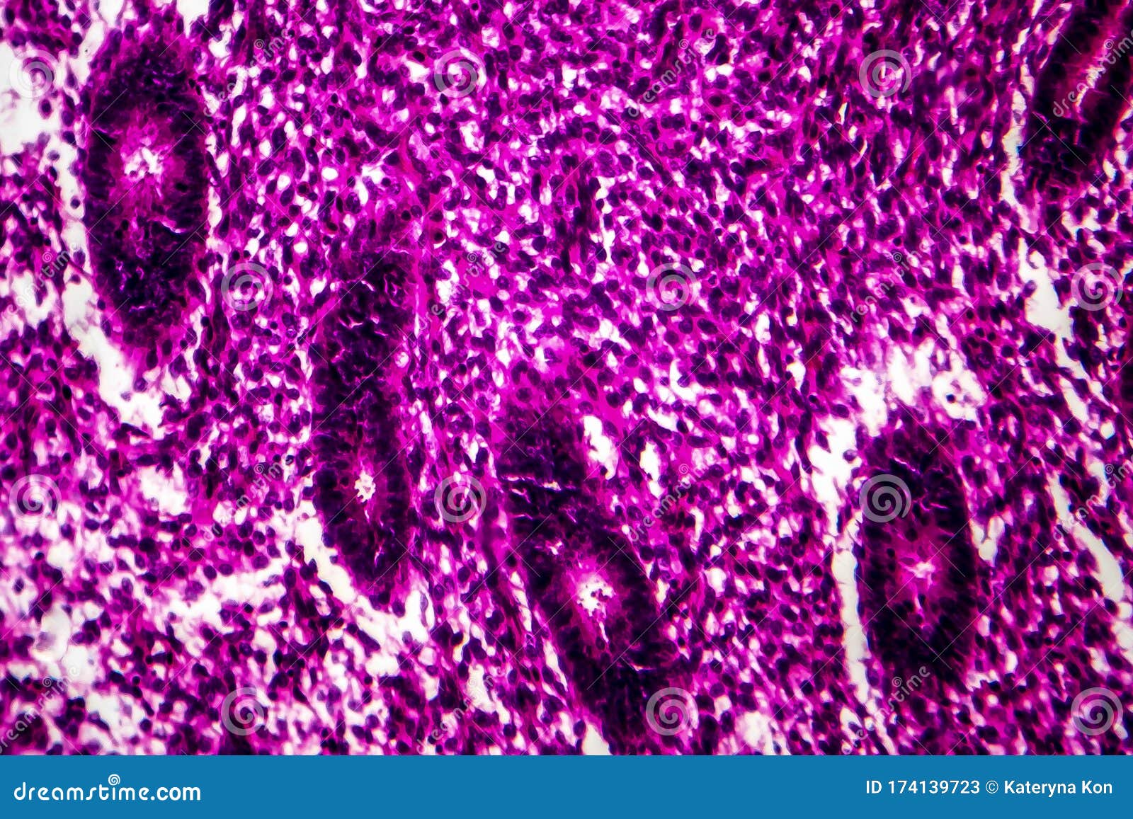 Endometrial Hyperplasia, Light Micrograph Stock Image - Image of micro ...