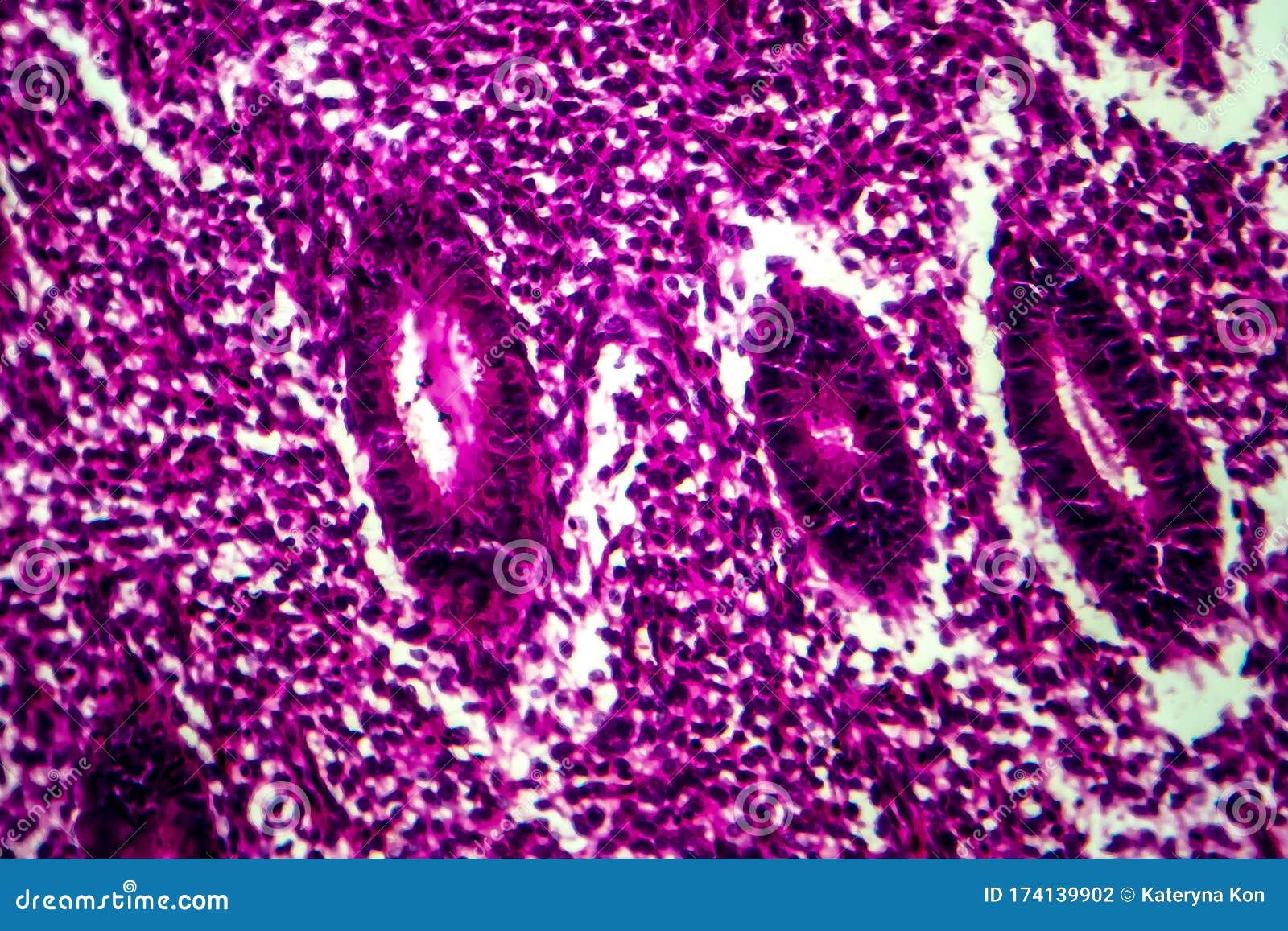 Endometrial Hyperplasia, Light Micrograph Stock Photo - Image of ...