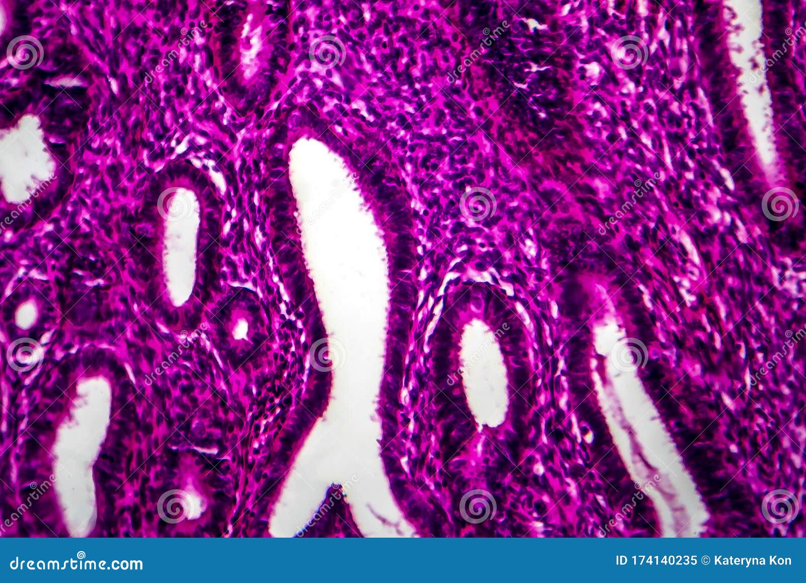 Endometrial Hyperplasia, Light Micrograph Stock Image - Image of ...