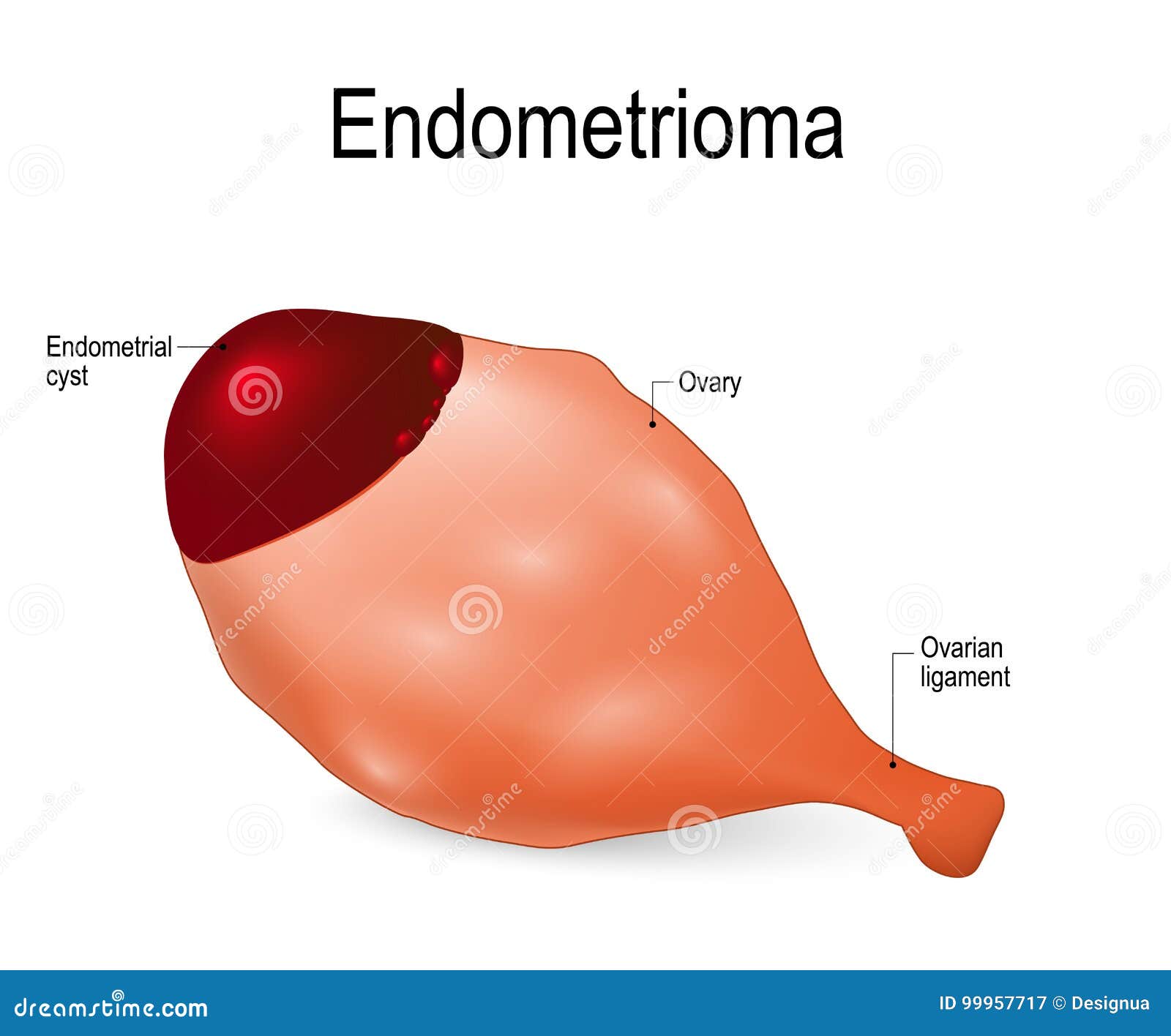 Endometrioma Endometrial Cysta Vektor Illustrationer - Illustration av ...